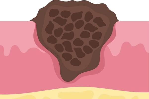 Fighting Cancer in India